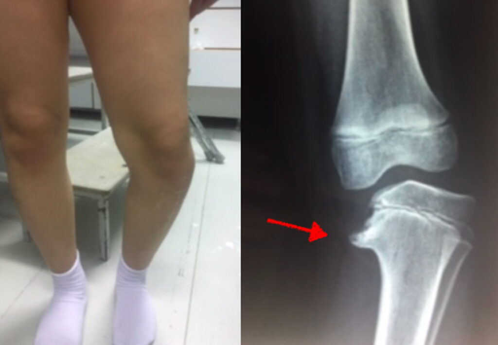 CÁC BIỂU HIỆN TẬT BÀN CHÂN PHỔ BIẾN CỦA TRẺ NHỎ - Phòng Khám Đau Cơ ...